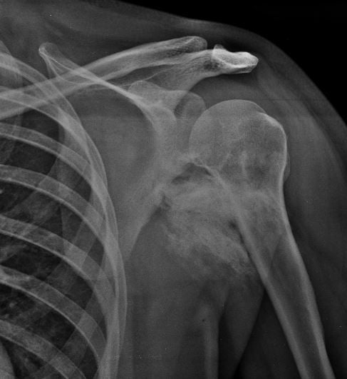 Osteossarcoma Parosteal