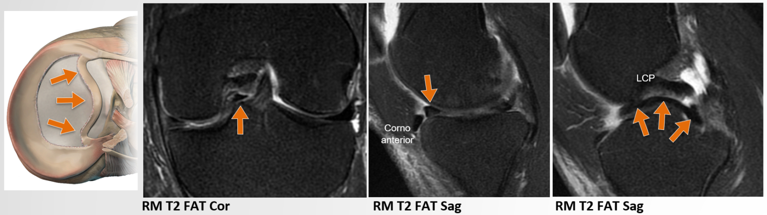 Lesão meniscal