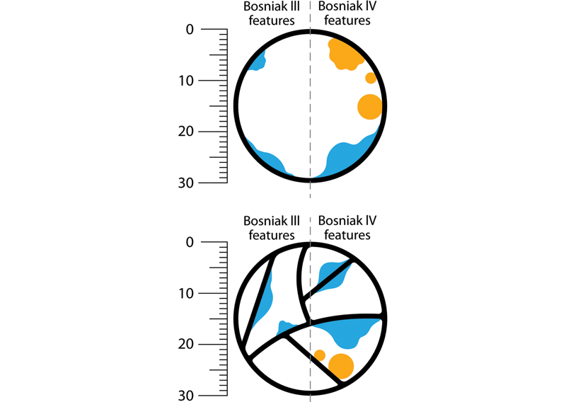 Cisto renal / Classificação de Bosniak
