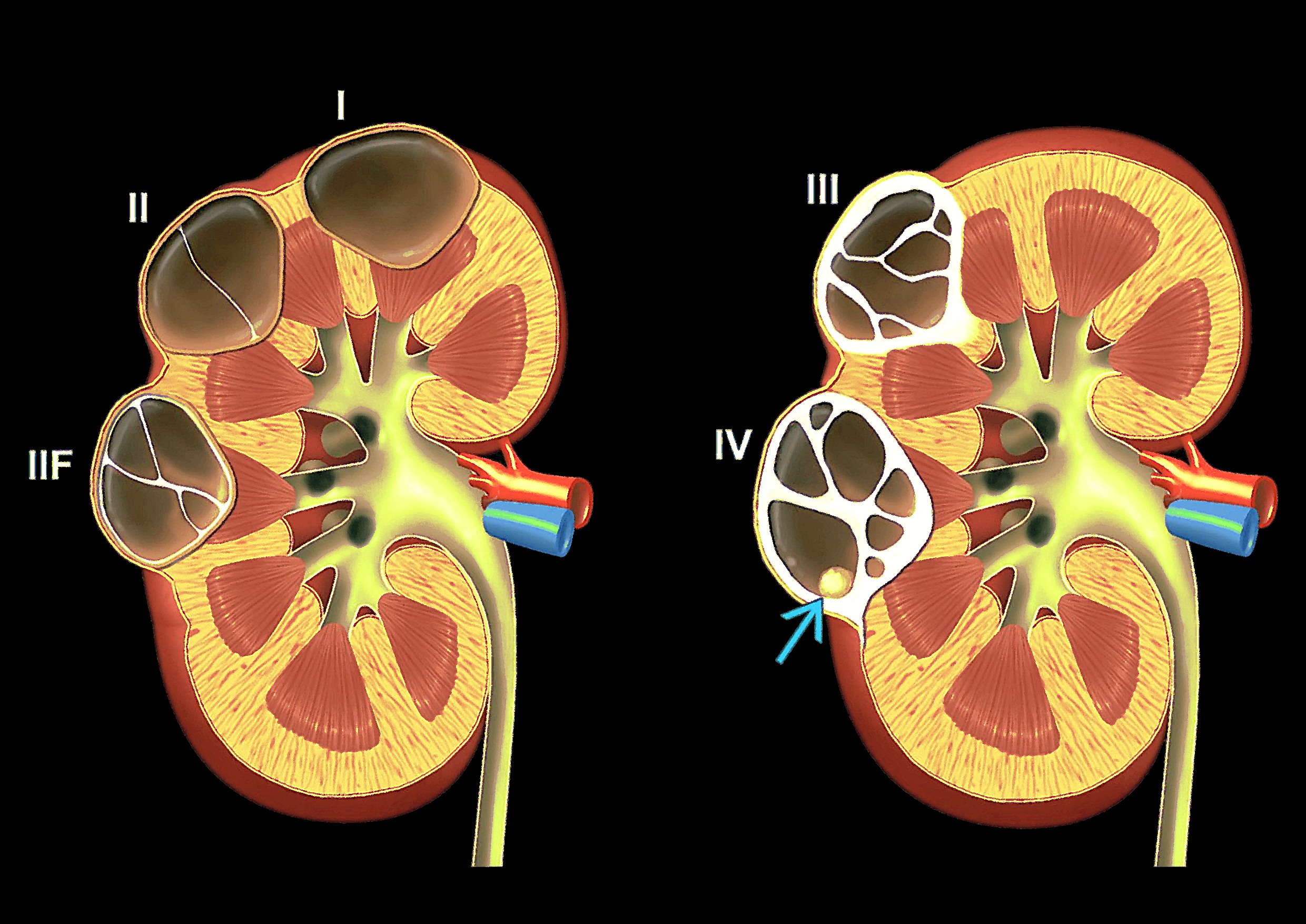 Ultrassonografia De Cisto Renal Ultrassonografia Hospital Amaral