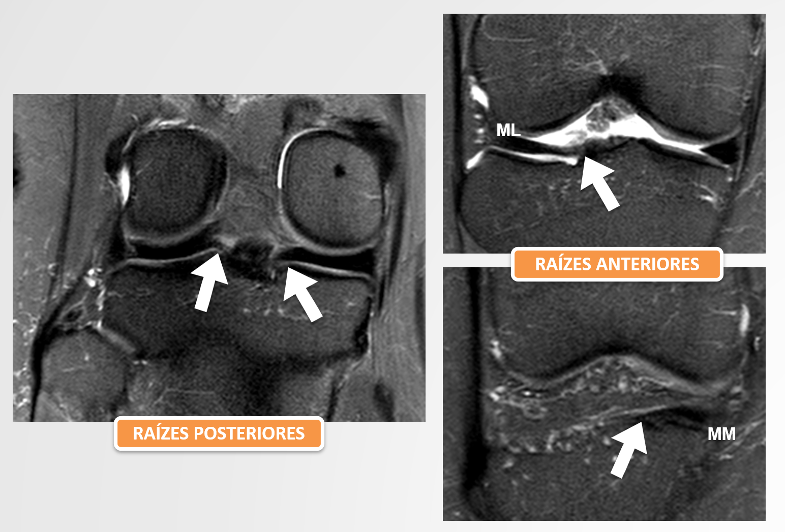 Lesão meniscal