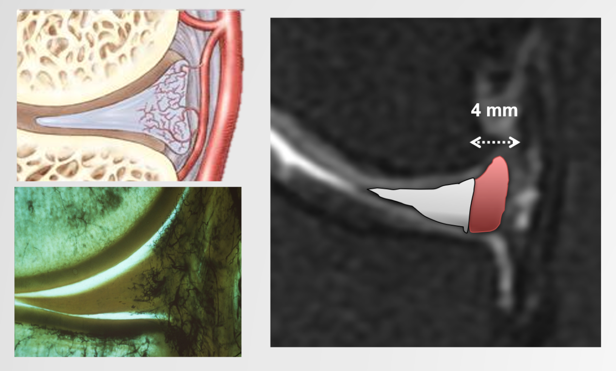 Lesão meniscal