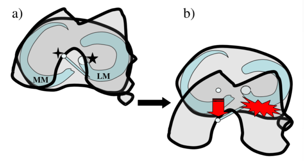 Lesão meniscal