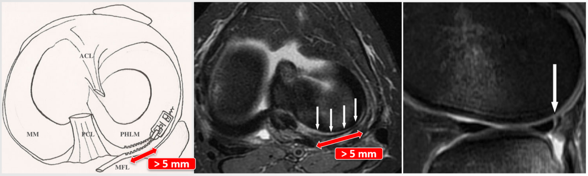 Lesão meniscal